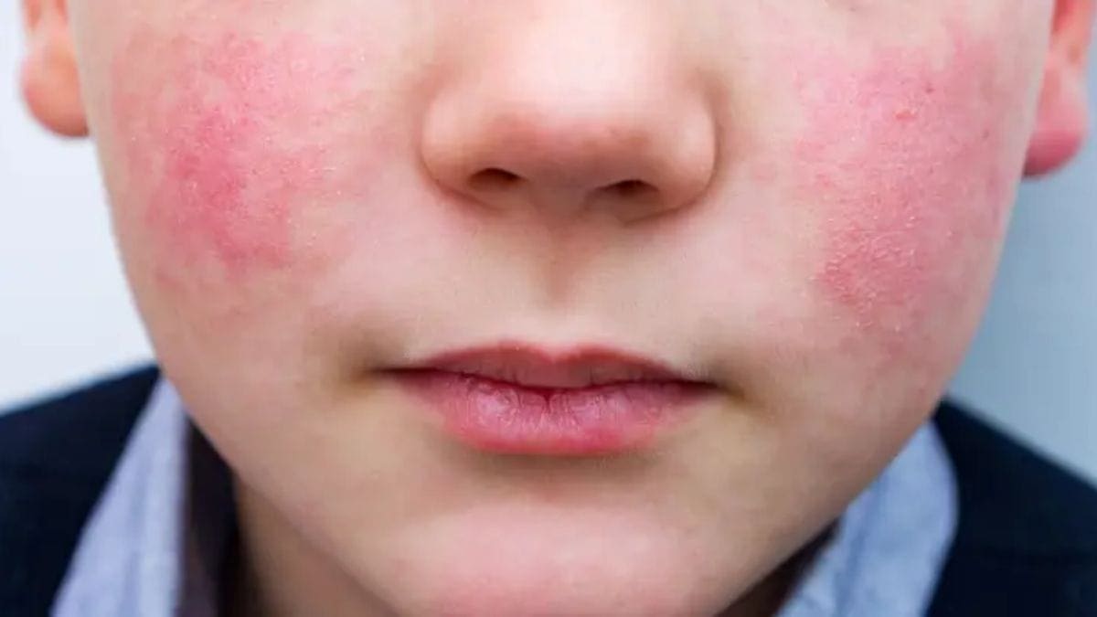 Alerta em SC: surto de doença que causa “bochecha esbofeteada” atinge ...